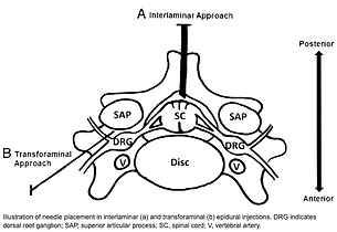 Endoscopic Spinal Surgery | Maars Medical