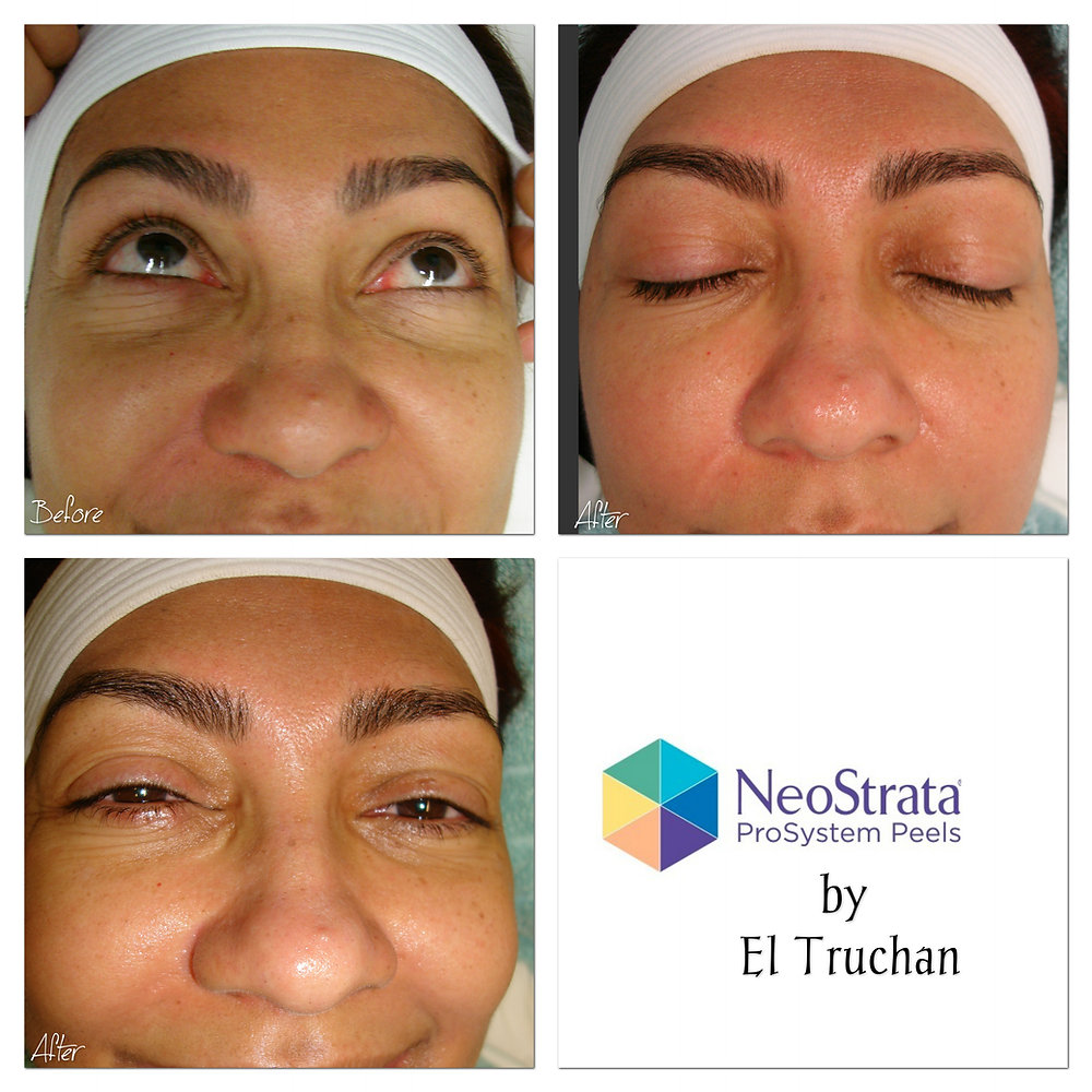 NeoStrata Chemical Peel - BEFORE & AFTER