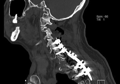 Posterior Cervical Pedicular Screws | Prodorth Spine