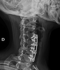 Spine Products | Prodorth Spine | Spinal Implants