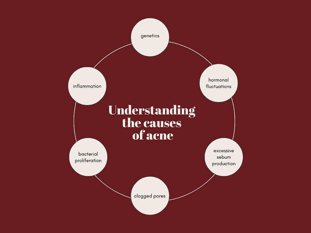 Understanding What Causes Acne and How We Can Treat It