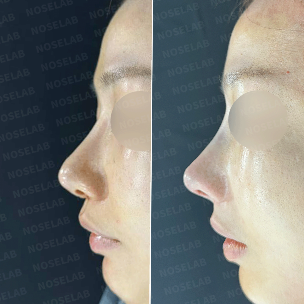 Revision Rhinoplasty with Autologous Rib Cartilage for Deviated Nose ...