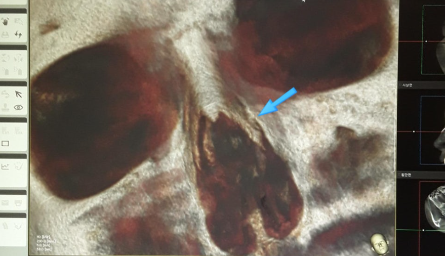 Rib Cartilage Reconstruction after Nasal Bone Collapse from Over ...