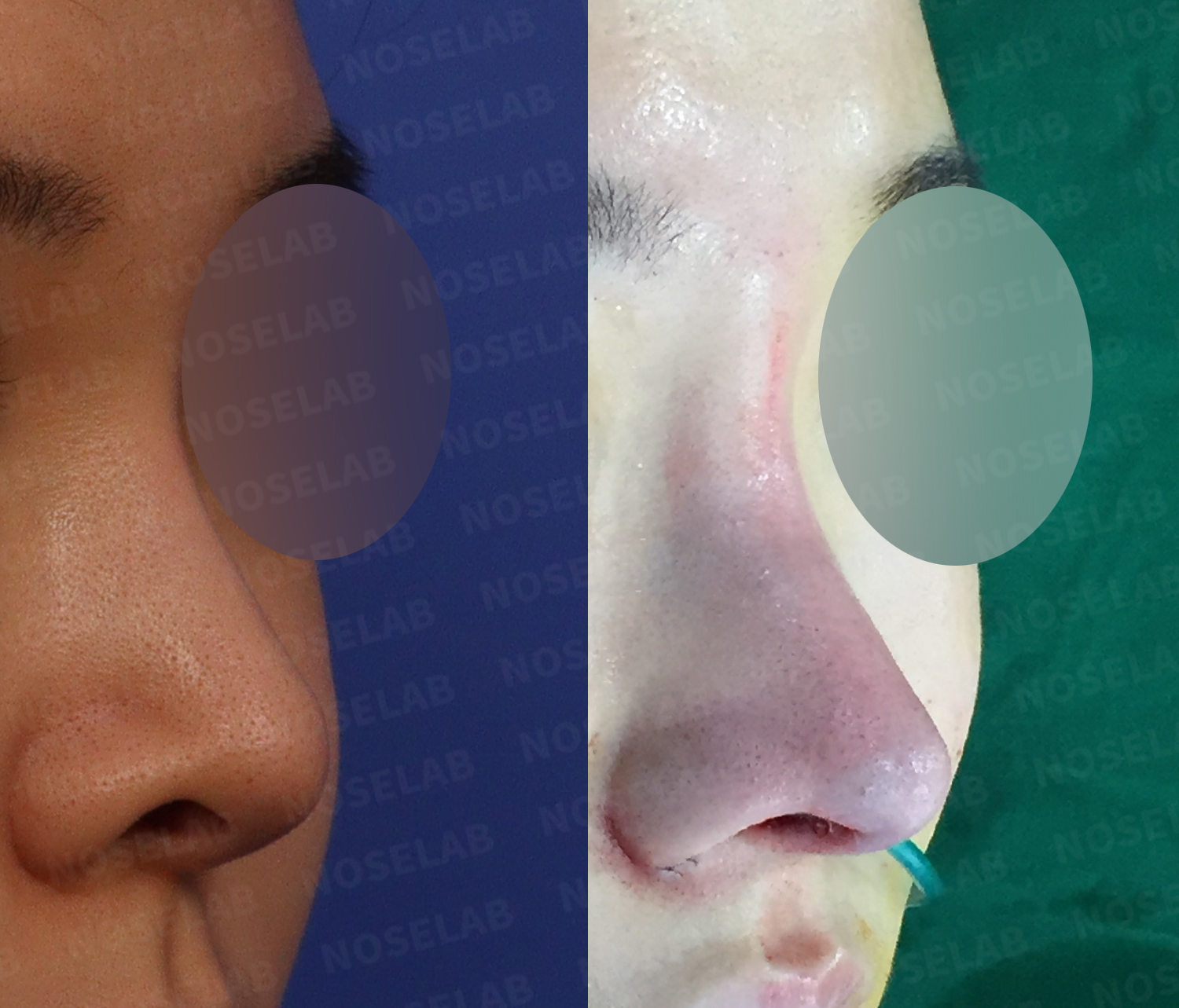 closed rhinoplasty + short nose + upturned nose + nostrils' asymmetry