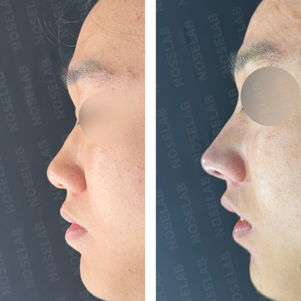 Case Study: Resolving Nasal Congestion and Enhancing Low Nasal Bridge ...