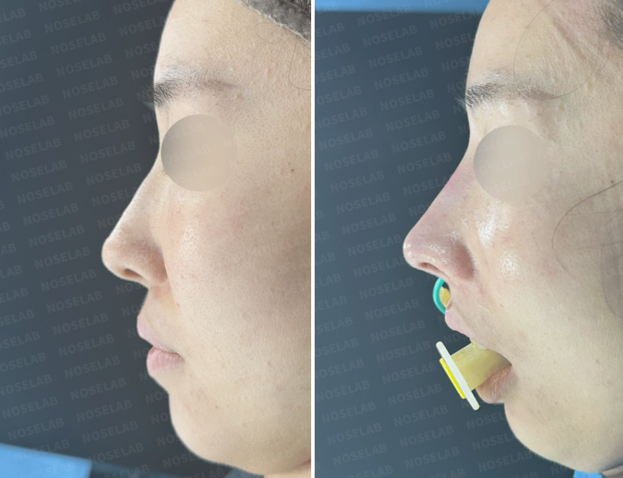 Rib Cartilage Reconstruction after Nasal Bone Collapse from Over ...