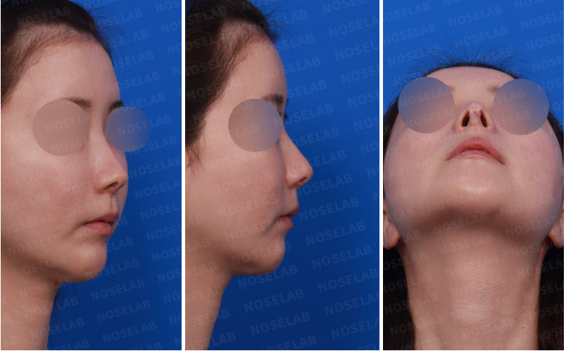 Refinement Surgery for a Higher, More Symmetrical Nose with Closed ...