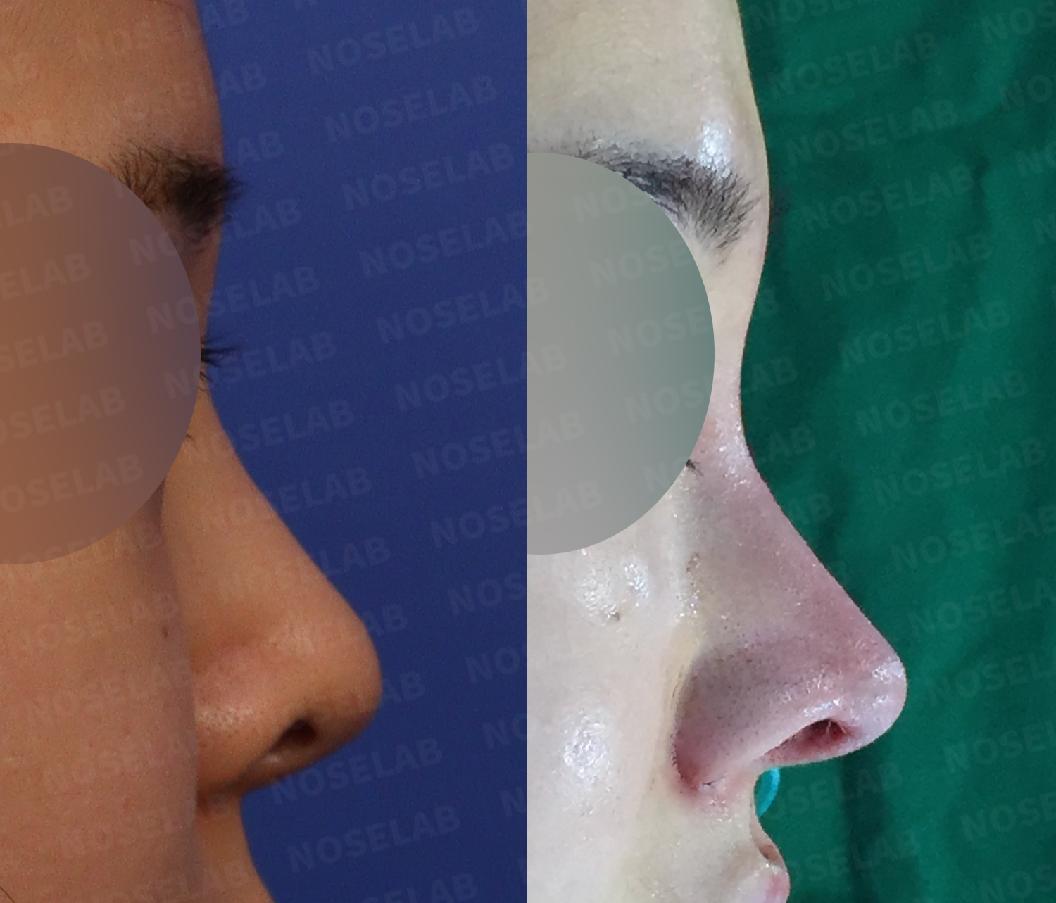 Closed Rhinoplasty Seoul – Short and Upturned Nose with Nostril ...