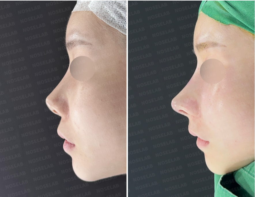 Columella Extension Rhinoplasty Korea for Over-Rotated Nose Correction