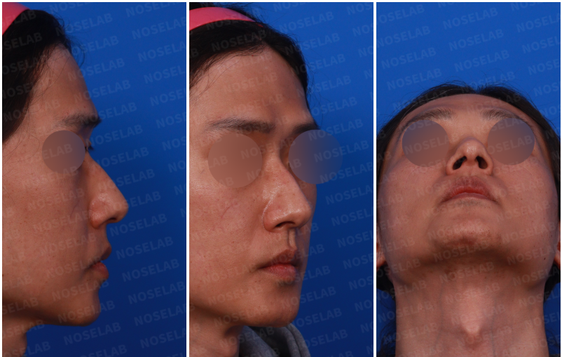 Closed 3D-Printed Dorsal Augmentation in Korea: Hump Correction and Tip ...