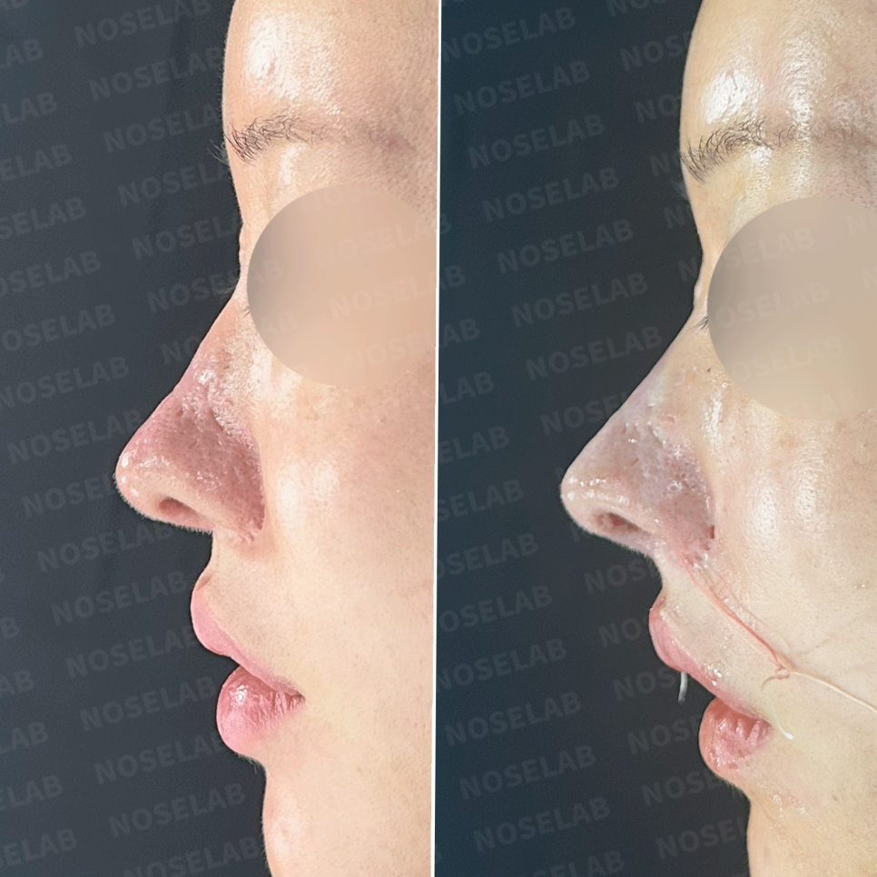 Nasal Skin Necrosis Correction in Korea – Complex Case of Nostril ...