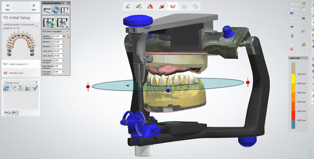 Digital vs conventional dentures