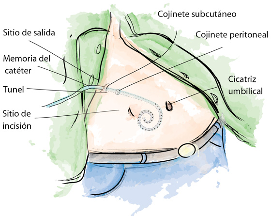 Cuidados del cateter de diálisis peritoneal