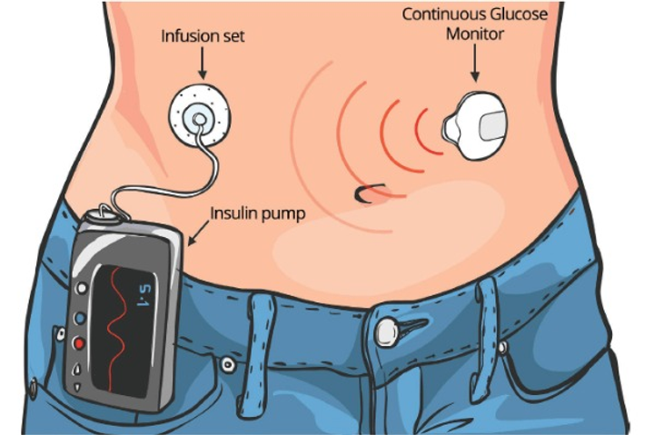Pump Patch: New Era In Insulin Delivery