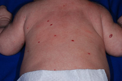 Types of Hemangiomas | HIG