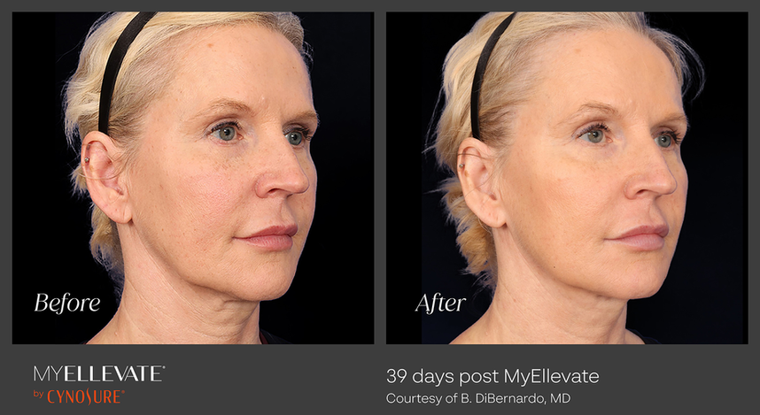 MyEllevate Jawline Contouring | Dubuque, Iowa | Faces Medspa