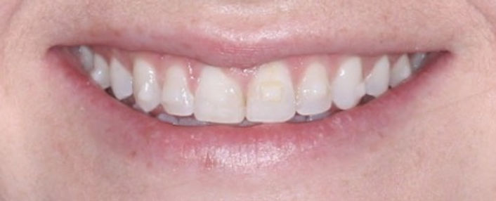 What Are Invisalign® Attachments? The ‘Bumps’ on Your Teeth Explained