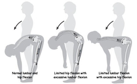 Low Back Pain After Deadlift