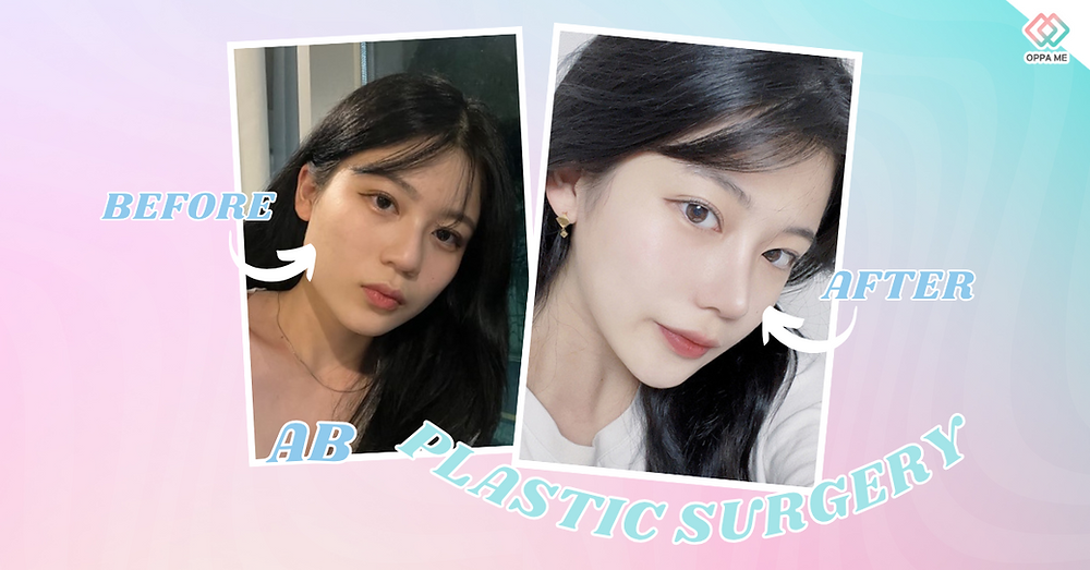 รีวิวทำโครงหน้า+จมูก ที่ รพ.เอบี (AB Plastic Surgery)