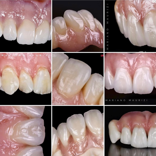 Morphology in Composite "Teeth & Gingiva'' with Mariano Maurizi ...