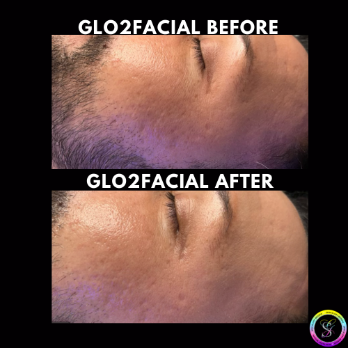 Unlock Radiant Skin with Geneo's Glo2Facial: A Deep Dive Glo2Facial ...
