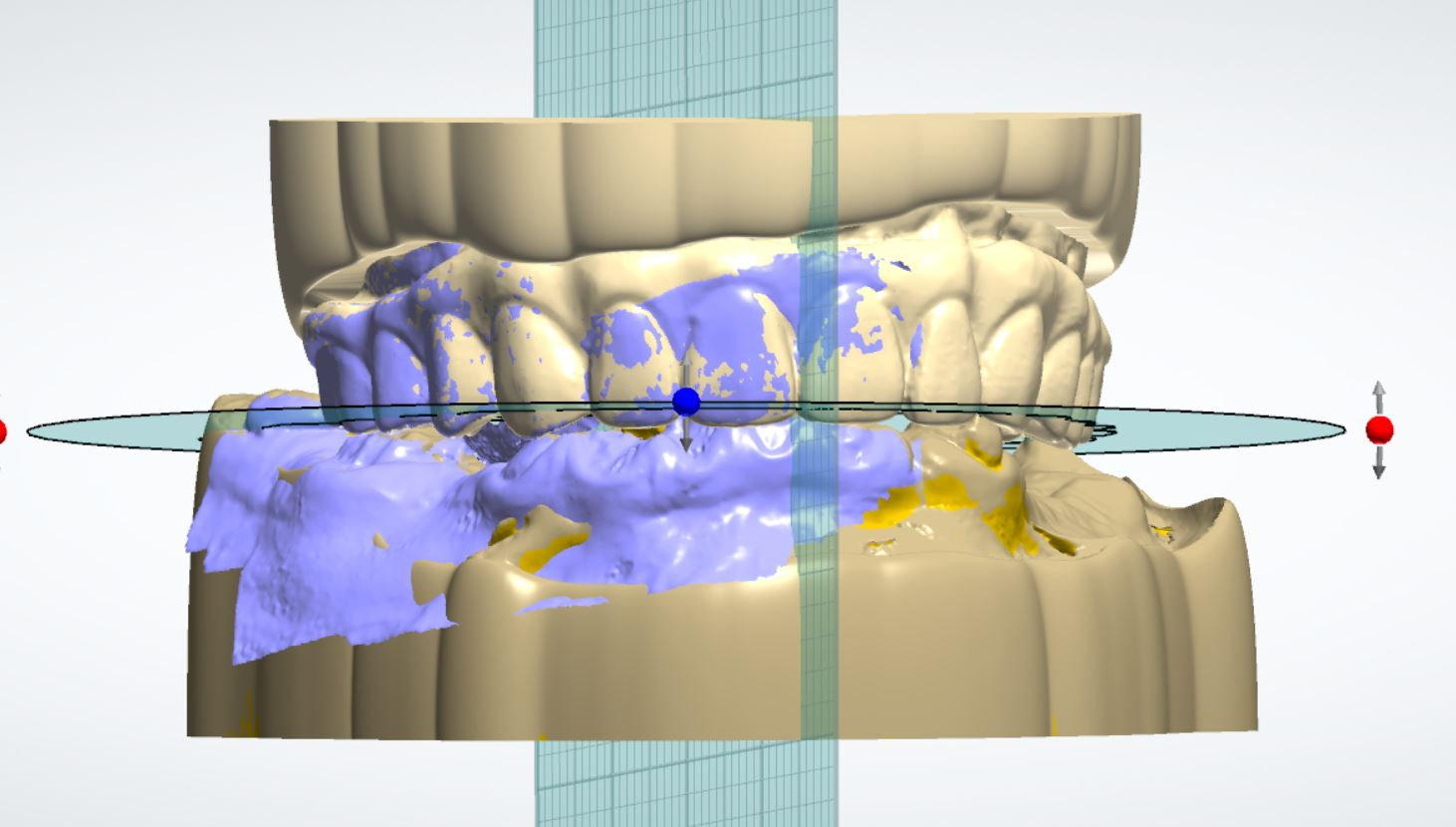 Diagnostic Denture Set-up for a CBCT Implant Guide | RDL Tech