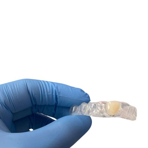 Retainer With Pontic | Bridge Dental Lab