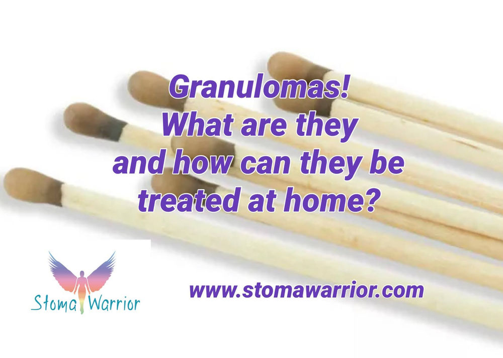 Granulomas! My experience treating large stoma granulomas!