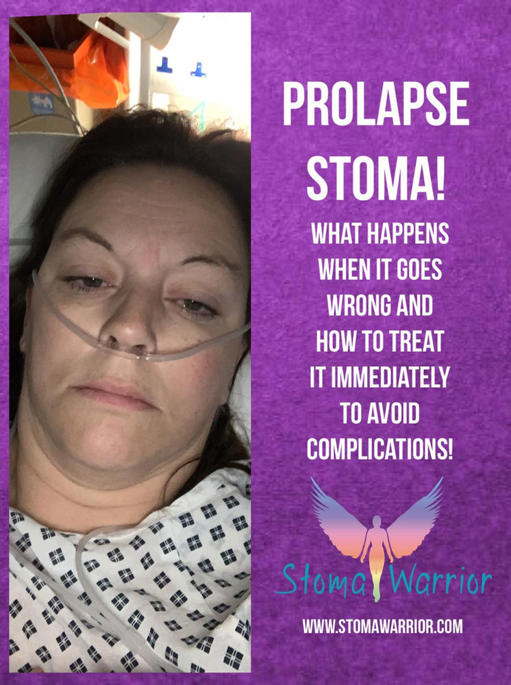 Prolapse Stoma! When it goes wrong and how to treat it early to avoid ...