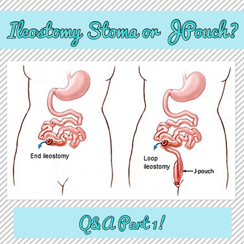 loop ileostomy icd 10