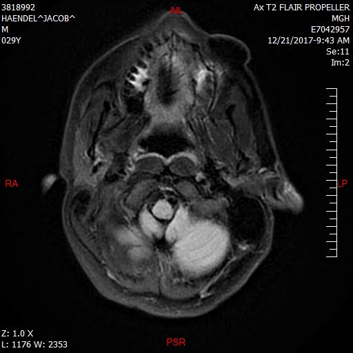Hypoxic Hallucinations: Realizations and Reflections