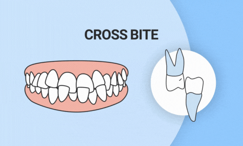 יישור שיניים שקוף באמצעות קשתיות בביוטק סמייל - מובילים באיכות וחדשנות