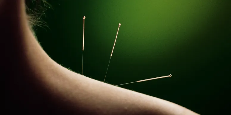 ACUPUNCTURE | Evolution of Wellnes