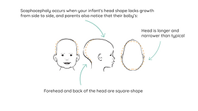 scaphocephaly head shape