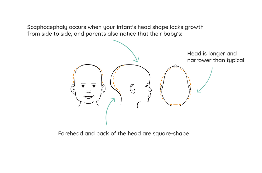 Scaphocephaly Treatment & Info | ROKband Headshape Clinics