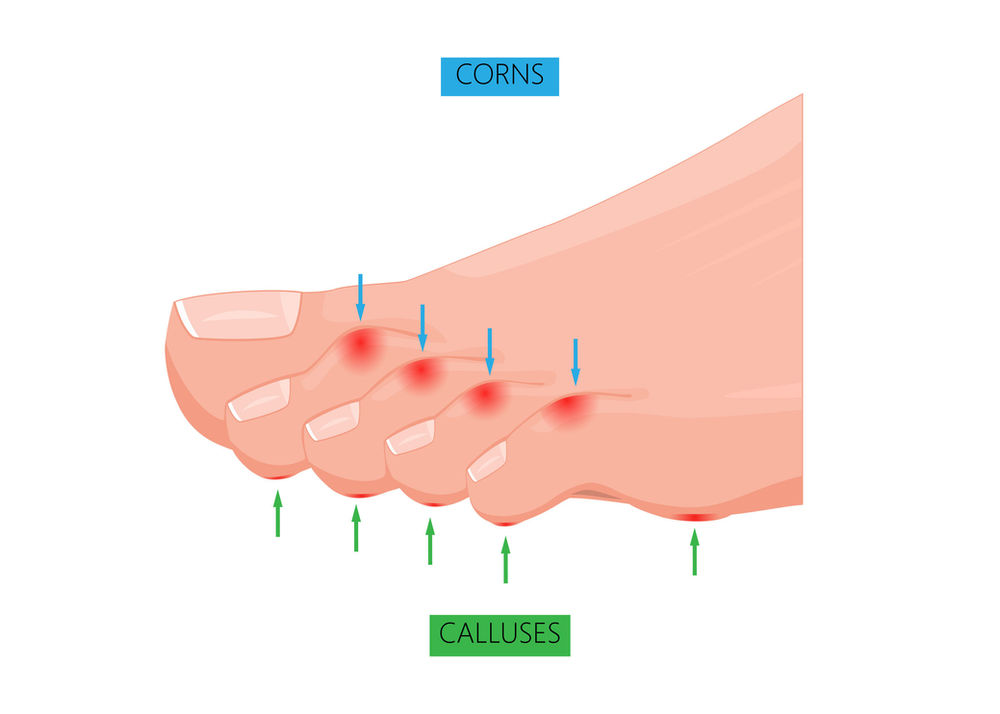 How To Treat Hammer Toes