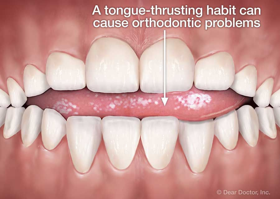 Tongue Thrust in Children and Adults: What You Should Know