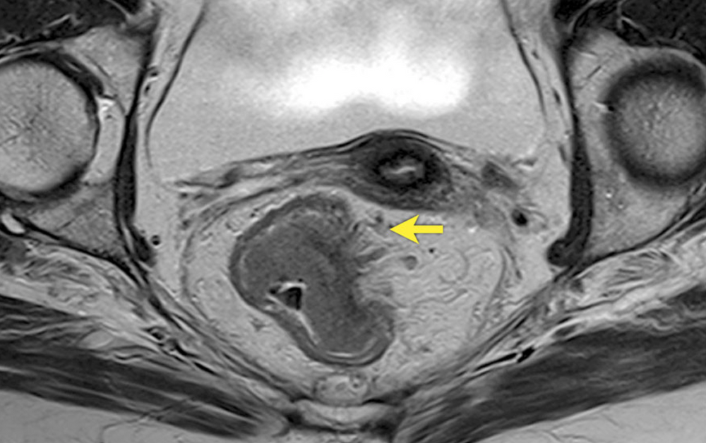 Novidades no tratamento do câncer do reto