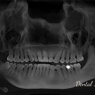 distal caries