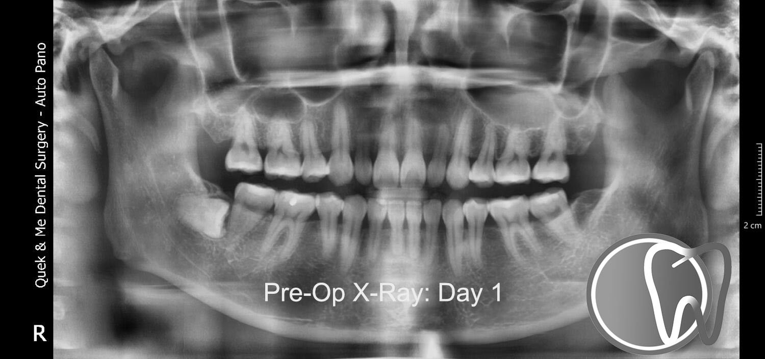 Removal of Impacted Tooth 48 with Bone Grafting for Bony Defect Distal ...