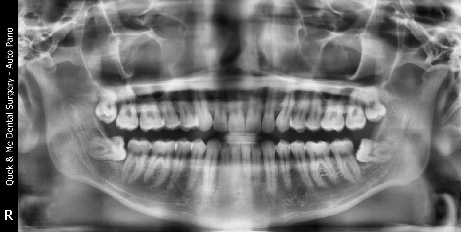 Removal of Impacted 48 and Non-functional 18