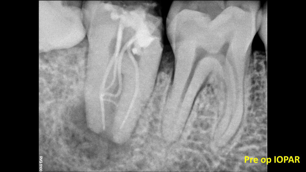 C shaped canals: Mandibular second molar