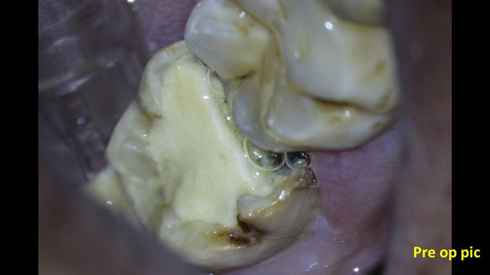 C shaped canals: Mandibular second molar