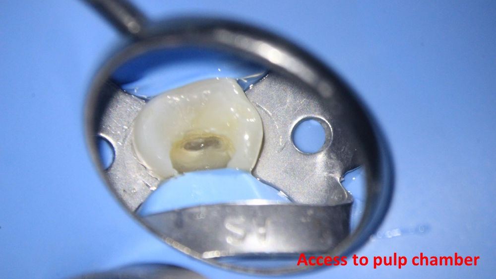 Upper Premolar Endo with adequate access