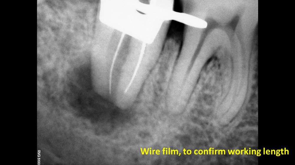 C shaped canals: Mandibular second molar
