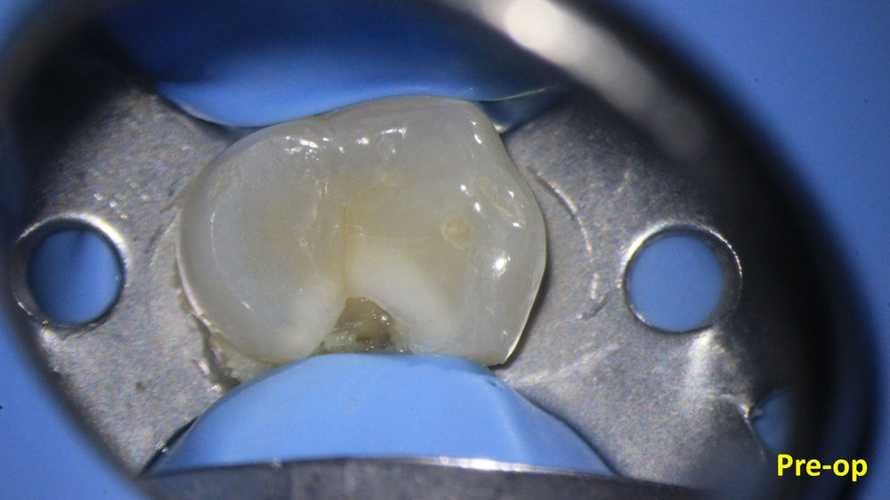 Upper Premolar Endo with adequate access