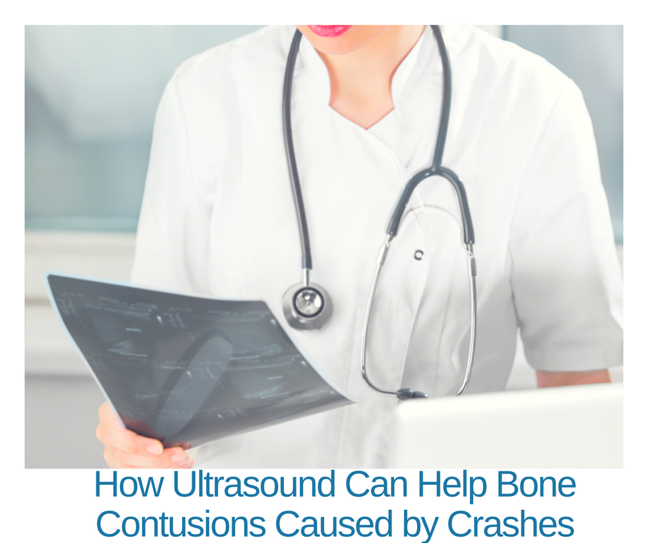 How Ultrasound Can Help Bone Contusions Caused by Crashes