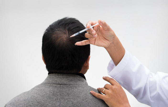 Alopecia Areata: Understanding the Causes, Symptoms, and Treatment