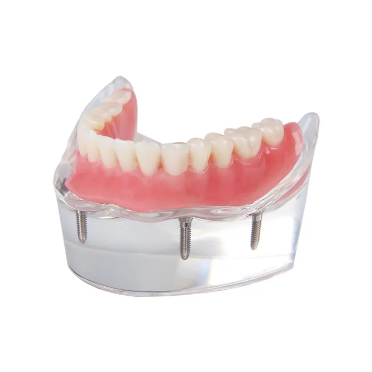Mandibular overdenture implant teeth model with 4 implants | Dentalshop Com
