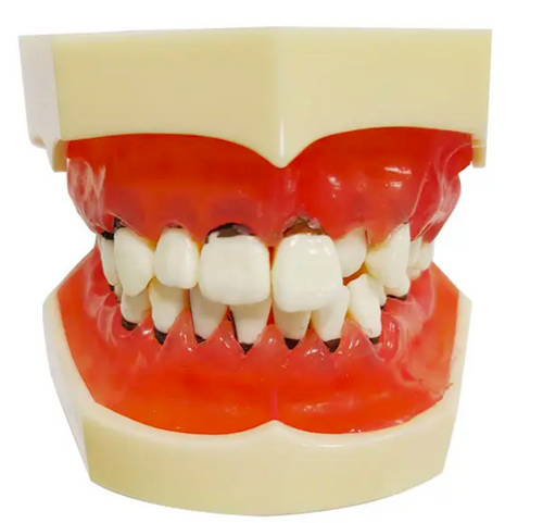 Dental Training Hard Gingivae Periodontal Disease Model with Calculus ...